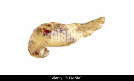 Pancreatitis disease of human pancreas isolated on white. Acute ...