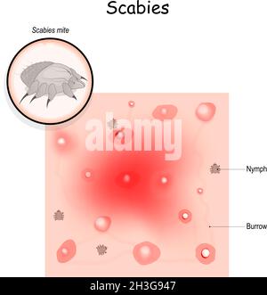 Scabies mite. Human's hand. skin with Rashes. seven-year itch is a ...