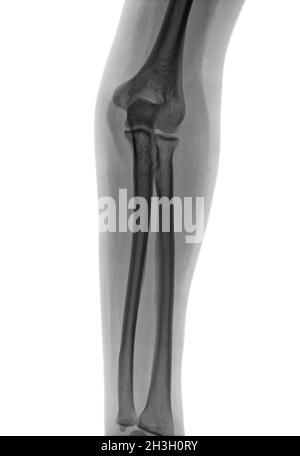 Elbow X-ray negative Stock Photo - Alamy