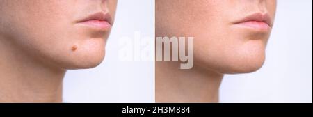 Medical treatment removal of birthmark from female patient's neck ...