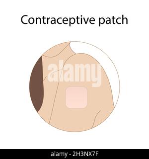 Contraceptive patch, illustration Stock Photo - Alamy