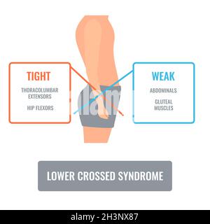Lower crossed syndrome, conceptual illustration Stock Photo - Alamy