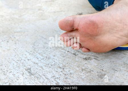 Athlete's foot fungal infection (tinea pedis) of the skin between the ...