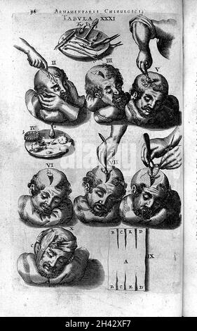 Johannes Scultetus, Armamentarium chirurgicum Stock Photo - Alamy