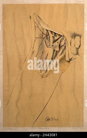 Dissection of the groin and upper thigh of a man, showing the blood ...