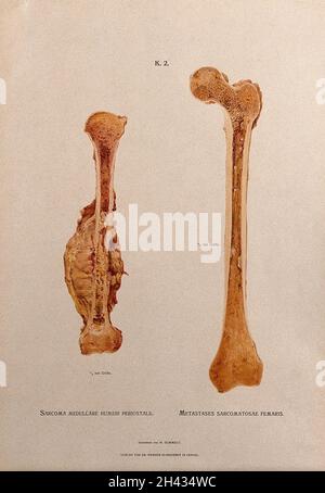 Sections through two femur bones: the left illustration indicating the ...