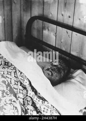 Gloucester smallpox epidemic, 1896: William Allen as a smallpox patient ...