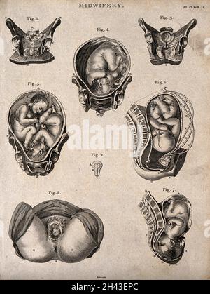 Eight diagrams illustrating babies in the womb in different positions ...