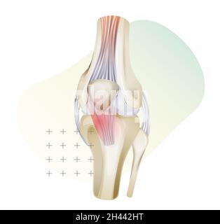 Medial knee ligament sprain medical vector illustration isolated on ...