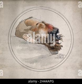 Face of a dead (?) man suffering from syphilis, showing a severely ...