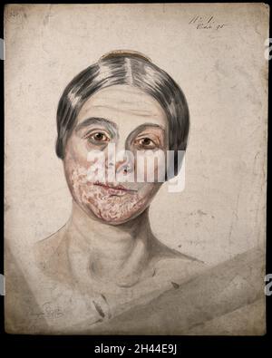 Head of a woman with a severe disease affecting her face. Watercolour ...