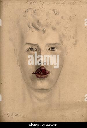 A man suffering from chancre of the lip, displaying sores and abcesses ...