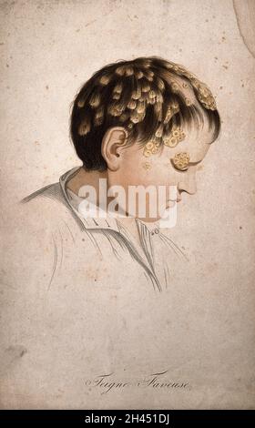 Head of a boy with skin disease. Coloured stipple engraving by S ...