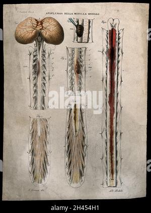 Several sections of diseased spinal cord, numbered for key. Coloured ...
