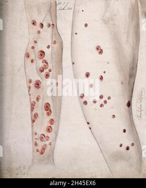 Diseased skin and sores on the leg of a man suffering from syphilis ...