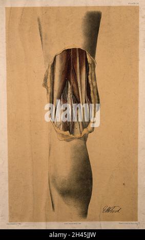 Dissection of the back of the thigh, showing the muscles, tendons ...