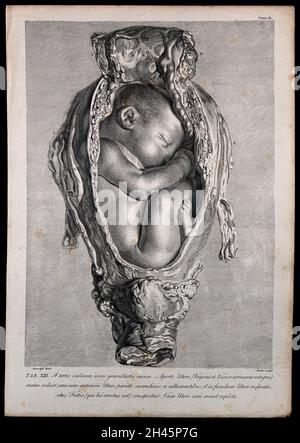 Dissection of the pregnant uterus, showing the foetus at six months ...