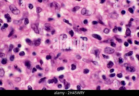 Post kala azar dermal leishmaniasis: skin lesion Stock Photo - Alamy