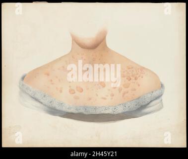 Pityriasis rosea skin rash. This skin disorder is thought to be viral ...