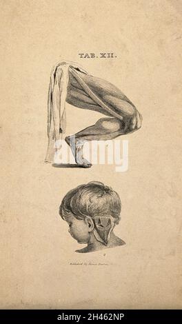 Dissection of the back of the lower leg, showing the muscles, arteries ...