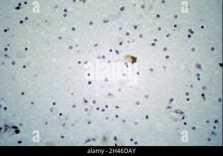 Brain: HIV encephalopathy Stock Photo - Alamy