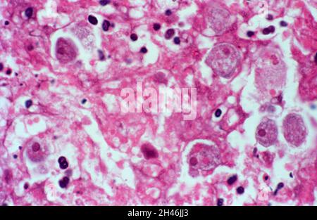 Skin: cutaneous amoebiasis Stock Photo - Alamy
