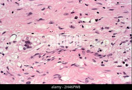 Lepromatous leprosy: type 2 ENL reaction Stock Photo - Alamy