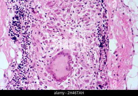 Leprosy: skin section Stock Photo - Alamy