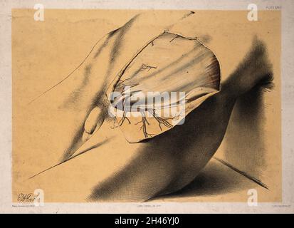 Dissection of the groin and lower abdomen of a man, with the muscles ...