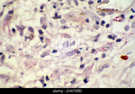 Leprosy: skin section Stock Photo - Alamy