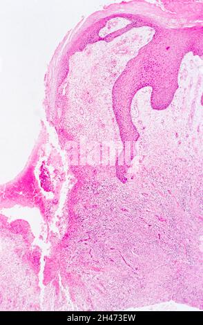 Skin: cutaneous amoebiasis Stock Photo - Alamy