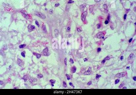 Leprosy: skin section Stock Photo - Alamy