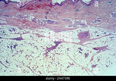 Diffuse lepromatous leprosy: Lucio phenomenon Stock Photo - Alamy