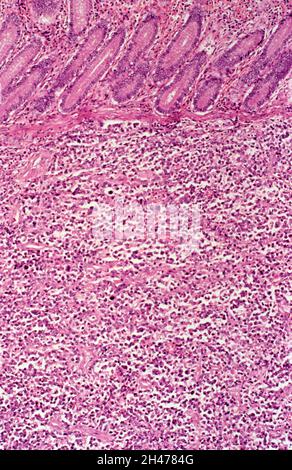 Lymphoma with HIV: colon Stock Photo - Alamy