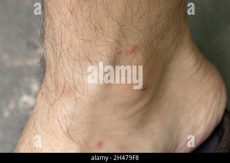 Human feet with various allergic reactions to tick bites with selective ...