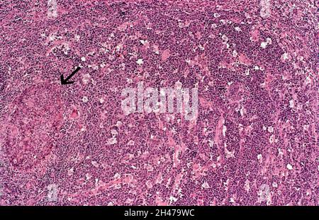 Parotid gland: lymphoepithelial cyst with HIV Stock Photo - Alamy