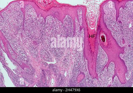 Cutaneous leishmaniasis: skin lesion Stock Photo - Alamy