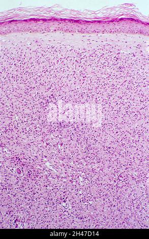 Leprosy: skin section Stock Photo - Alamy