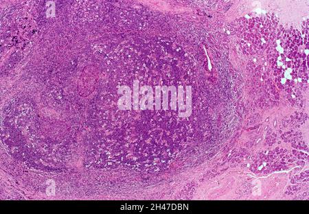 Parotid gland: lymphoepithelial cyst with HIV Stock Photo - Alamy