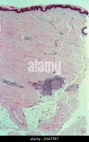 Leprosy: borderline tuberculoid leprosy, skin Stock Photo - Alamy