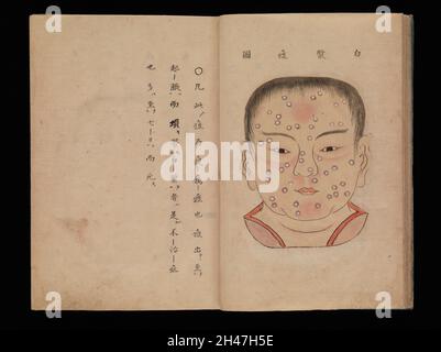 Smallpox illustration, Japanese manuscript, c. 1720 Stock Photo - Alamy