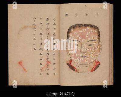 Smallpox illustration, Japanese manuscript, c. 1720 Stock Photo - Alamy