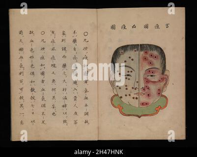 Smallpox illustration, Japanese manuscript, c. 1720 Stock Photo - Alamy