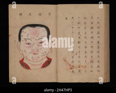 Smallpox illustration, Japanese manuscript, c. 1720 Stock Photo - Alamy