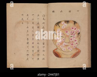Smallpox illustration, Japanese manuscript, c. 1720 Stock Photo - Alamy