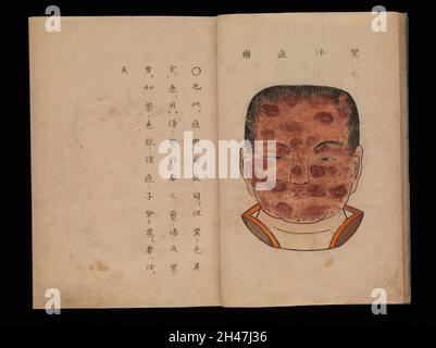 Smallpox illustration, Japanese manuscript, c. 1720 Stock Photo - Alamy
