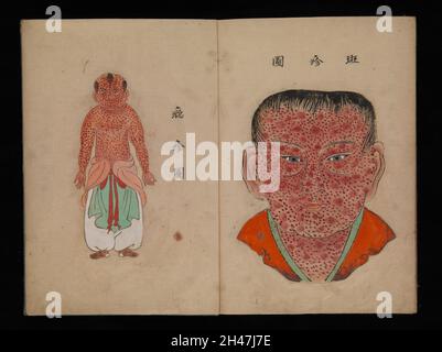 Smallpox illustration, Japanese manuscript, c. 1720 Stock Photo - Alamy
