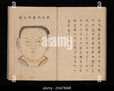Smallpox illustration, Japanese manuscript, c. 1720 Stock Photo - Alamy