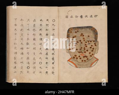 Smallpox illustration, Japanese manuscript, c. 1720 Stock Photo - Alamy