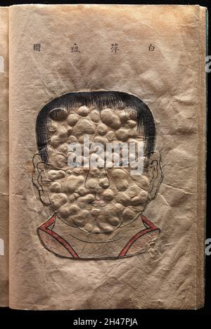 Smallpox, textured illustration, Japanese manuscript, c. 1720 Stock ...